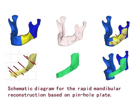 How To Reconstruct Mandibular Defect Within 2mm Deviation Rapidly Iadr Abstract Archives