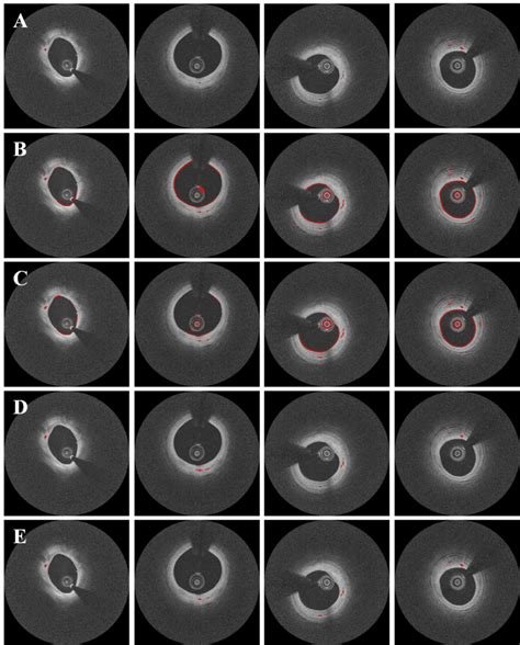 Segmentation Results With And Without Data Augmentation And