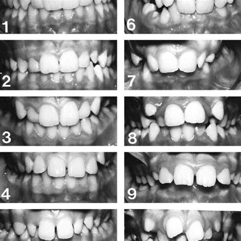 The Aesthetic Component Ac Of The Iotn Rycina 1 Składowa Estetyczna Ac