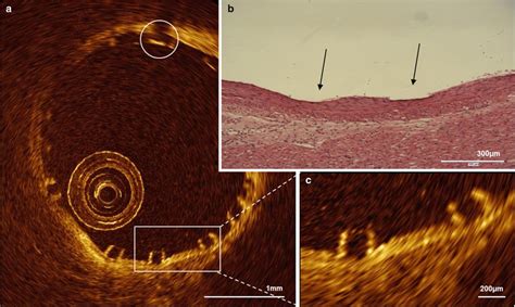 Bioabsorbable Stent Radiology Key