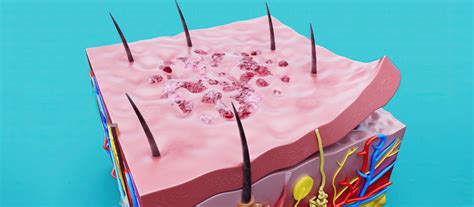 Cellulitis Ailments Mgmch Jaipur