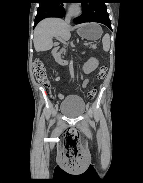 Using Point Of Care Ultrasound To Expedite Diagnosis Of Necrotizing Fasciitis A Case Report Jetem