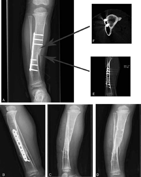 One Year After The Operation Parts A And B X Ray Showed The Shape Of