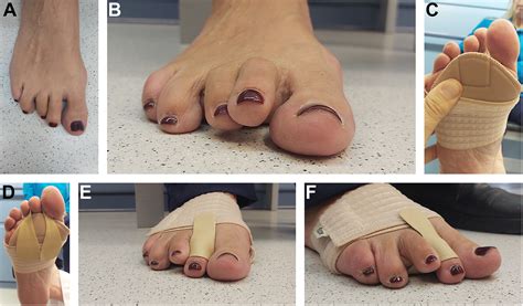 Orthotics For The Treatment Of Lesser Toe Deformities Foot And Ankle