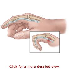 Patient Education Article Columbia Orthopaedic Group Patient Education