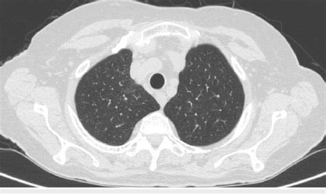 High Resolution Chest Ct Showing Diffuse Centrilobular Micronodules Download Scientific Diagram