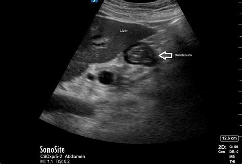 Repeat Pocus Examination With Arrow Pointing Towards The Duodenum A Download Scientific