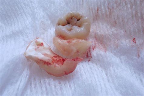 Wisdom Teeth Pictures