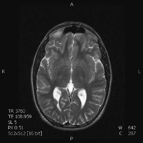 Subependymal Heterotopia T2 Weighted Se Image Shows A Gray Matter Download Scientific Diagram