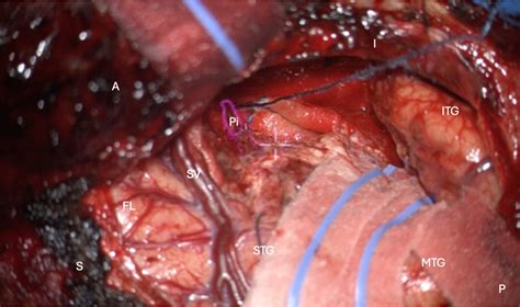 Improving Outcomes In Anteromesial Temporal Lobe Resections A