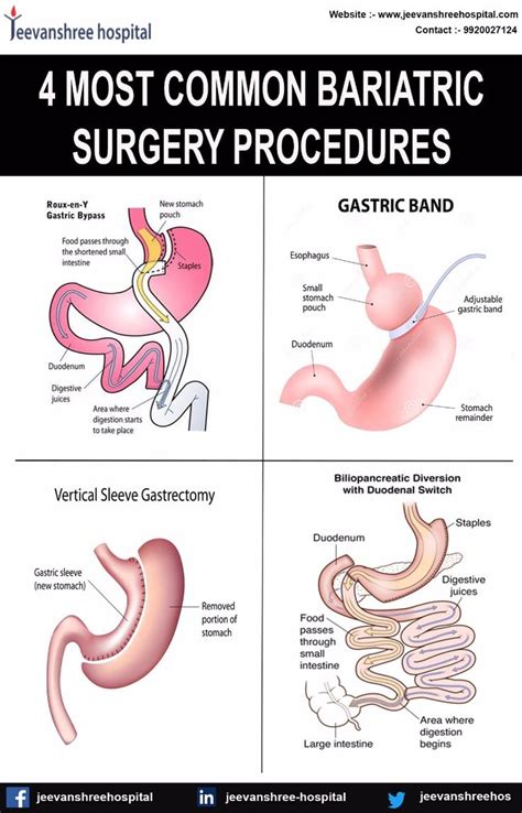 pin on general surgery coding