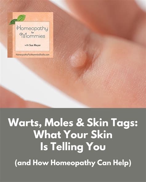 Warts Moles And Skin Tags What Your Skin Is Telling You And How