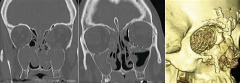A 65 Year Old Woman Presenting With Panfacial Fractures Underwent A Download Scientific Diagram