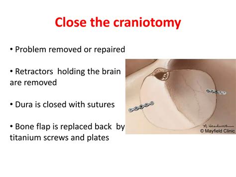 Craniotomy Pptx
