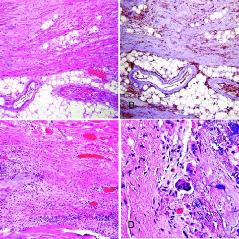 Heart A Fibrosis In The Heart Atrio Ventricular Nodal Area B CD Download Scientific