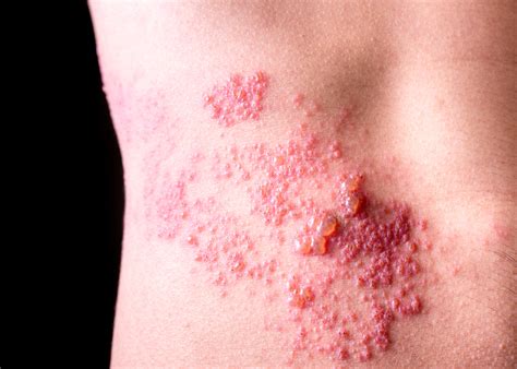 Myhealth1st What Is Shingles And Am I At Risk Of Getting It