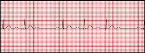 Solved Which Identifies What Is Occurring On This EKG Sinus Chegg Com