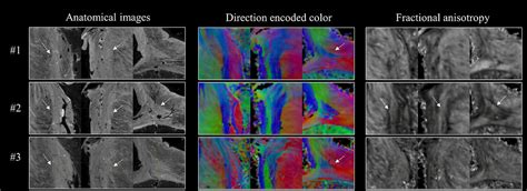 General Questions For Atlas Creation With Non Odf Data Tractography