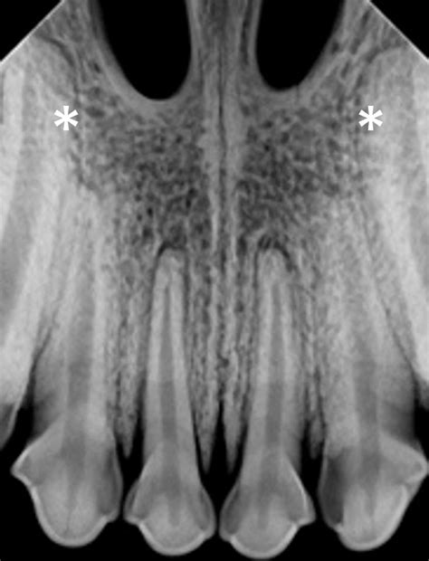 Zygomatic Process Radiograph Submento Vertex X Ray Showing Left