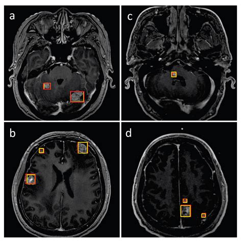 Cancers Free Full Text Automatic Detection Of Brain Metastases In T1 Weighted Construct