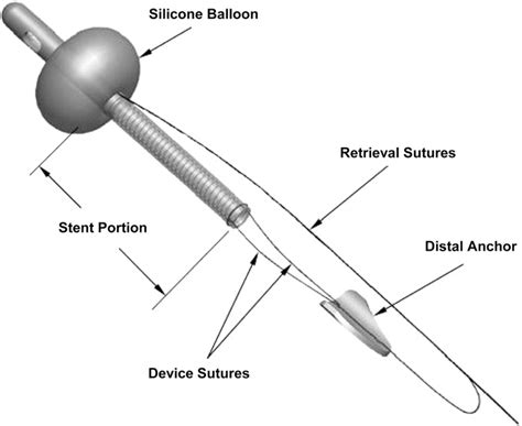Figure 1 From A Temporary Intraurethral Prostatic Stent Relieves Prostatic Obstruction Following