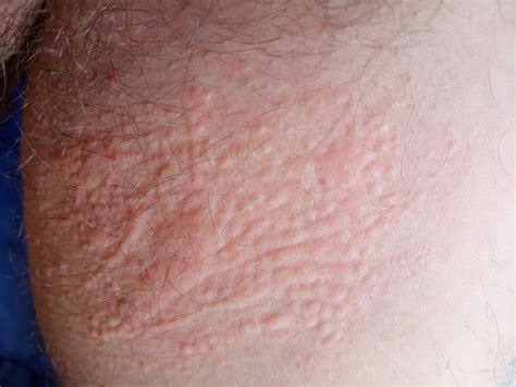 Is This Scabies R Scabies