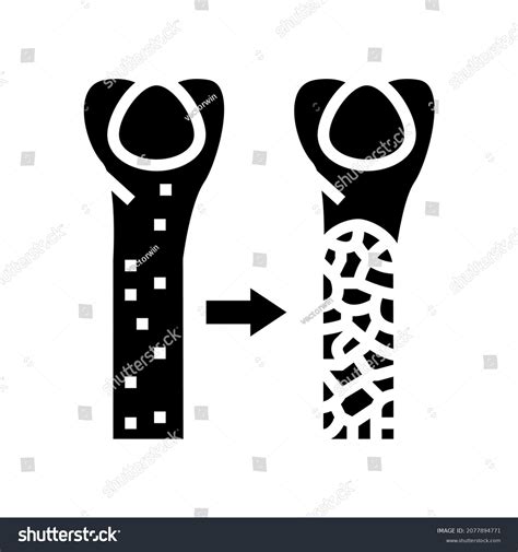 Osteoporosis Bone Disease Glyph Icon Vector Stock Vector Royalty Free
