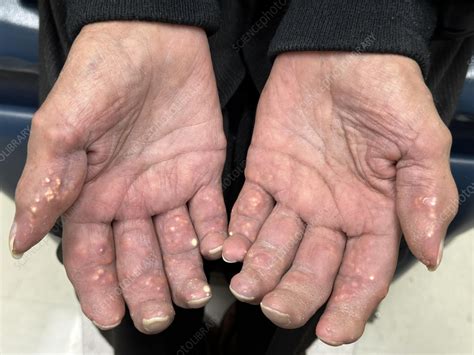 Calcinosis Scleroderma The Scleroderma Hand Manifestations Of Disease
