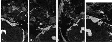 Examples Of Types Of Aica Loops And Eighth Cn Aica