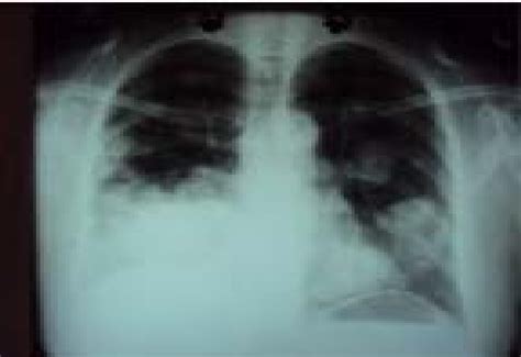 Chest Radiograph Showing Lungs Metastases With Right Pleural Effusion