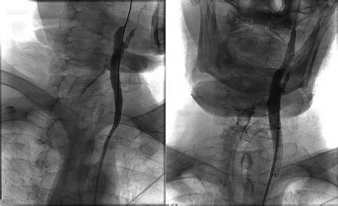 Unexpected Cause Of Recurrent Epistaxis Bmj Case Reports