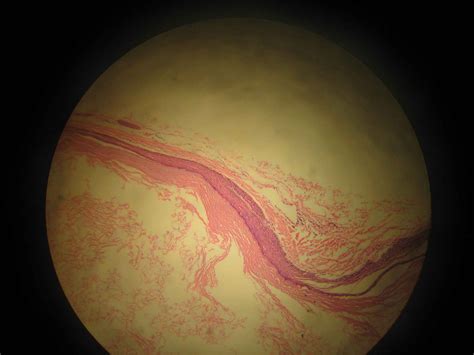 Dentistry And Medicine Dermoid And Epidermoid Cyst