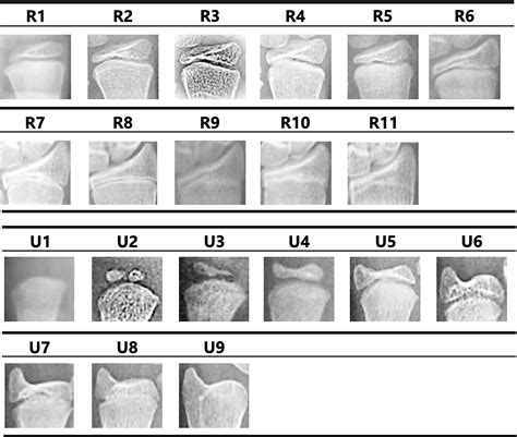 figure 2 from skeletal maturity recognition using a fully automated