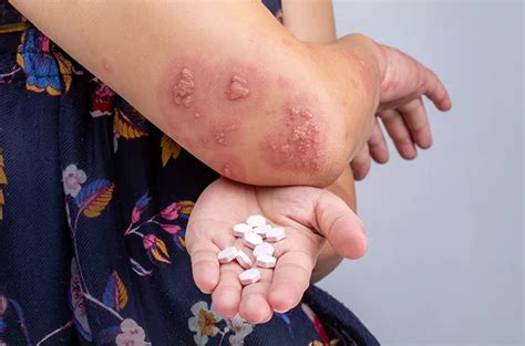 Herpes Zoster Mengenal Icd 10 Dan Pengobatannya