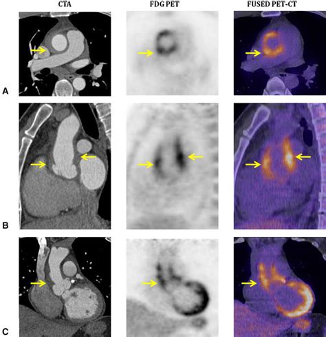 Utility Of Multimodality Imaging In Diagnosis And Follow Up Of Aortitis