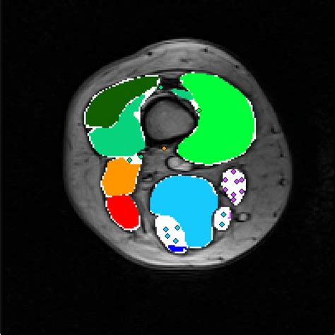 Segmentation Results Using Automatic Seeds Segmentation Errors Are