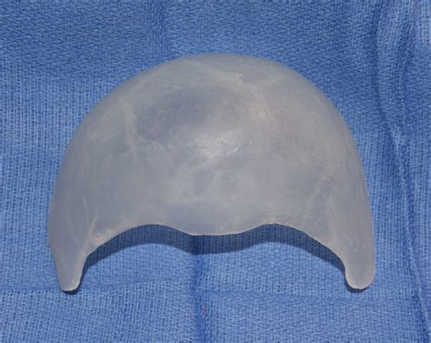 Plastic Surgery Case Study Female Custom Widening Forehead Temporal Implant Explore Plastic