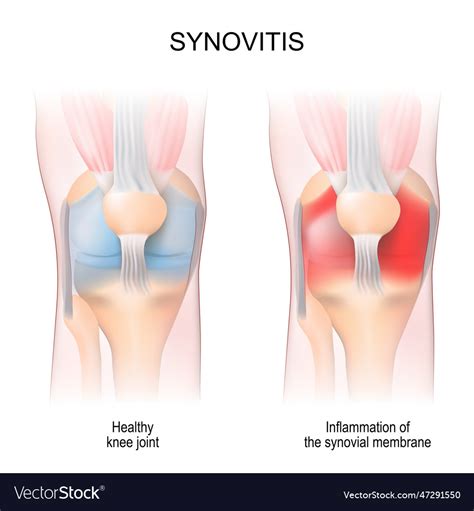 Synovitis Human Knee Joint Anatomy Royalty Free Vector Image