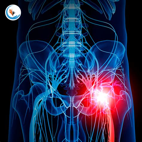 Sciatica Problem Homeopathic Clinic Ahmedabad
