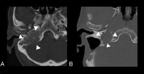 Demonstration Of Two Distinctive Patterns Of Bone Involvement Note The