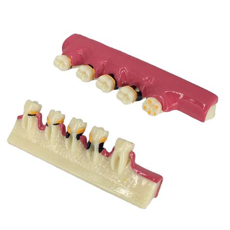 Xieji Periodontitis Periodontal Disease Classification Model Dental