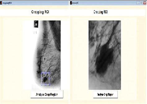 an automated mammogram classification system using modified support ve