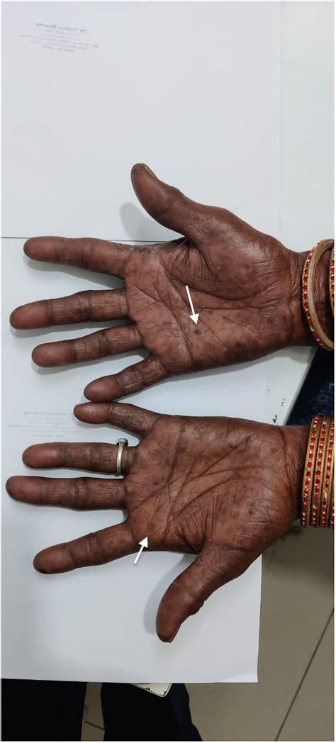 Diffuse Mucocutaneous Hyperpigmentation Related To Hydroxyurea Hematology Transfusion And