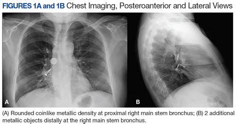 Flexible Bronchoscopic Removal Of 3 Foreign Objects Federal Practitioner