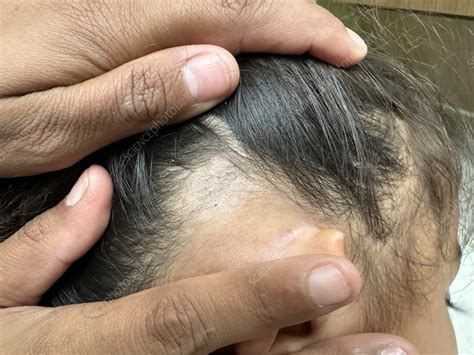 Ringworm Of The Scalp Stock Image C060 4789 Science Photo Library
