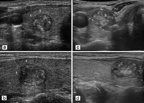 thyroid ultrasound nodule