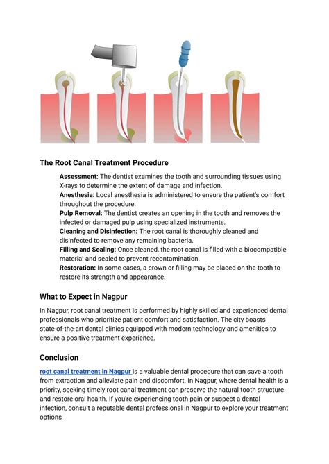 Root Canal Treatment Procedure Step By Step Ppt At Laura Burke Blog