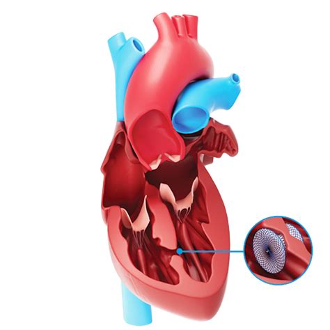Ventricular Septal Defect Treatment Vsd Closure