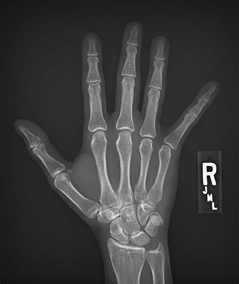 Can Anyone Spot The Fracture For Those Who Can Would You Expect This Fracture To Require