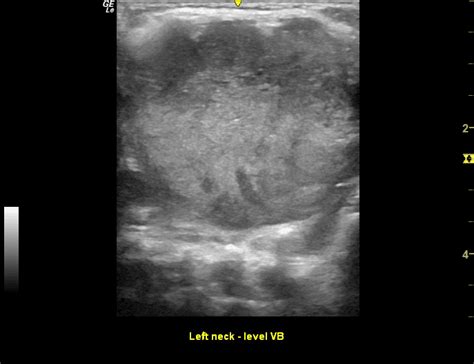 A Rare Cause Of Neck Lump In An Infant Pocus Journal